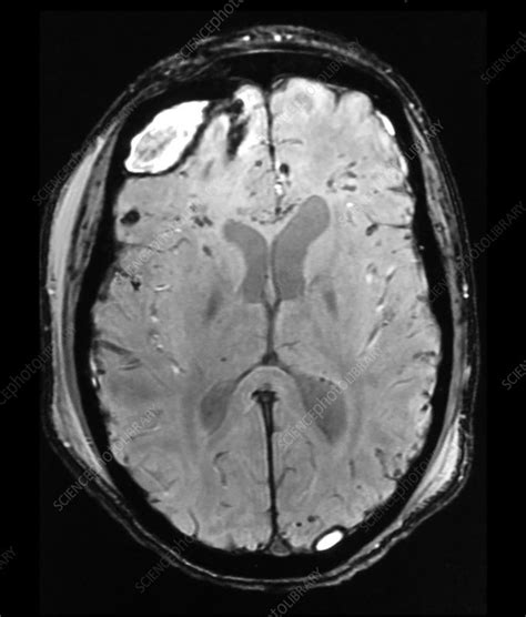 Traumatic Brain Injury Mri Stock Image C0432978 Science Photo