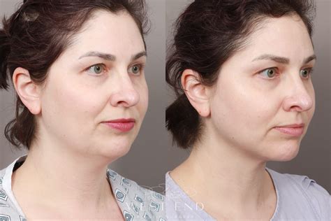 Liposuction And Renuvion Skin Tightening 15 Months Post Op Before