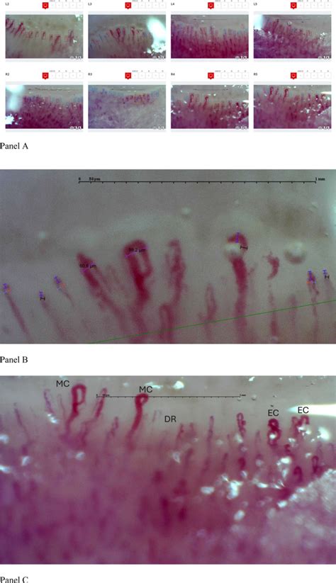 Multifactorial Induction Of A “scleroderma‐like Pattern” Without Underlying Connective Tissue