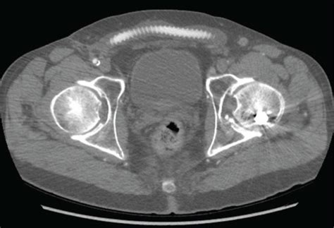 Fluid Surrounding The Femorofemoral Bypass Graft Download Scientific Diagram
