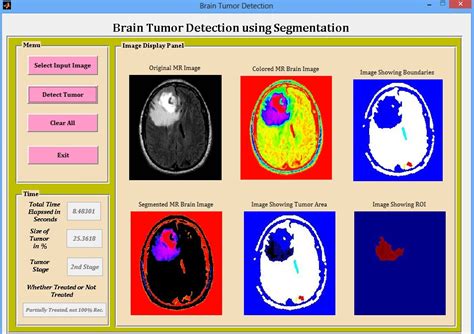 An Efficient Brain Tumor Detection Algorithm Using Watershed And Segmentation Methods ~ Matlab