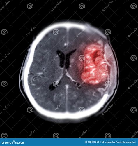 Mri Brain Axial Views To Evaluate Brain Tumor Glioblastoma Brain Metastasis Isodensity Mass