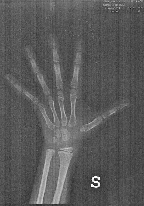 Gelastic Seizures Bone Age X Ray