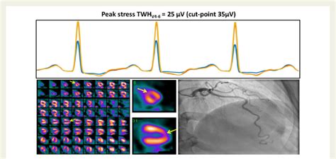 False Positive MPI Perfusion Defect With Negative Angiogram And Download Scientific Diagram