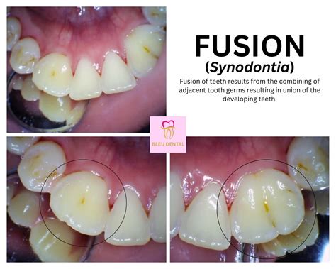 Tooth Fusion Where Boundaries Dont Bleu Dental Clinic Facebook