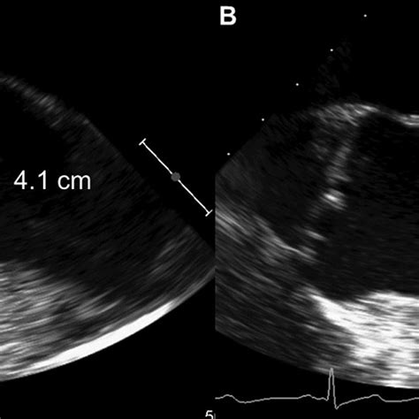 Tee Images Demonstrating Dilation Of The Aortic Root A And Ascending