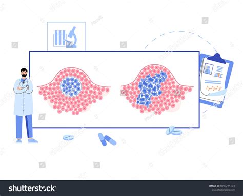 Vector Isolated Illustration Malignant Benign Tumor Stock Vector