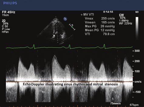 Cardiac Ultrasound Doppler Evaluation Of Mitral Valve Gradient