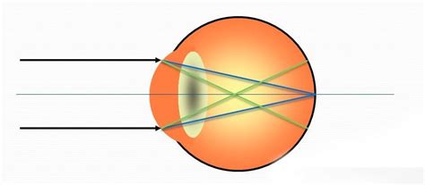 Simple Myopic Astigmatism New