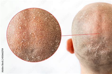 Male Bald Flaky Head With Dandruff Close Up Back View White