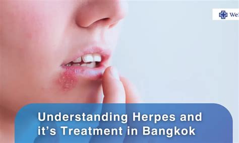 Herpes Men Treatment