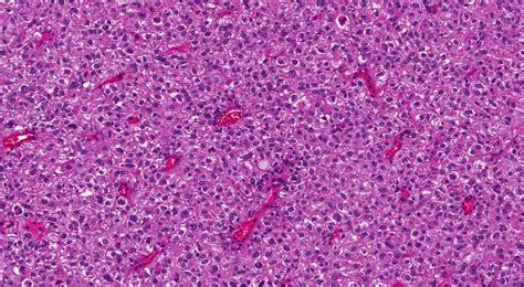 Epithelioid Angiomyolipoma Ottawa Atlas Of Pathology
