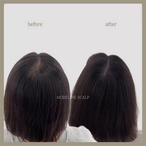 여자 정수리 두피문신 모드라인 마곡두피문신 마곡smp 서울smp 서울두피문신 강서구smp 강서구두피문신 Youtube