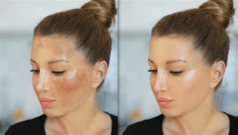 9 Tips On How To Remove Dark Spots On Face