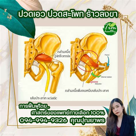 ปวดเอว ปวดสะโพก ร้าวลงขา สัญญาณเตือนโรคที่ซ้อนเร้น Piriformis Syndrome กล้ามเนื้อสะโพกหนีบ