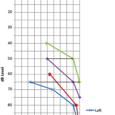 a unaided pure tone audiogram b right aided audiogram using the