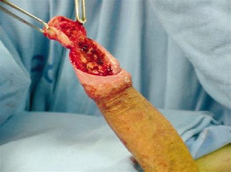 Figure 2 From Partial Glansectomy For Invasive Glans Penis Cancer And Immediate Reconstruction
