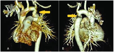 Ct Aortogram 3 Dimensional Volume Rendering Technique 3d Vrt Download Scientific Diagram