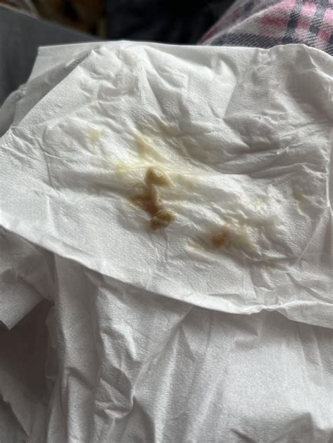 Bacterial Infection Chronic Sinusitis R Sinusitis