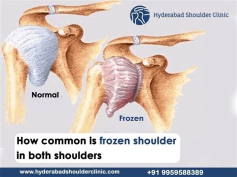 How Common Is Frozen Shoulder In Both Shoulders Shoulder Clinic