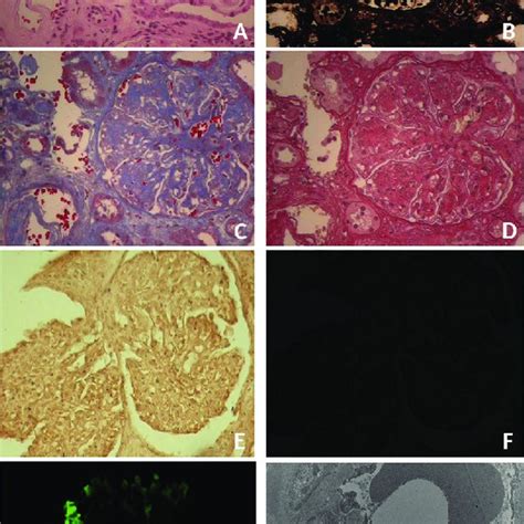 Pdf Nodular Glomerulosclerosis In A Non Diabetic Hypertensive Dyslipidemic Smoker Patient A