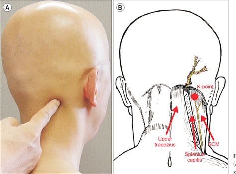 Splenius Capitis Trigger Point Splenius Capitis Trigger Point