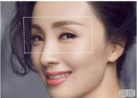眼窝凹陷填充脂肪有风险吗 蜜颜优惠