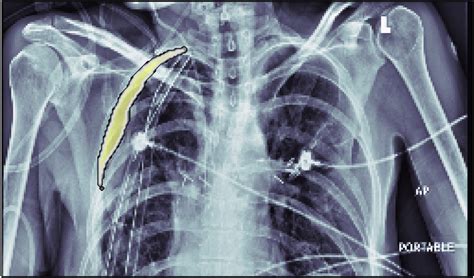 Dectection Of Pneumothorax Using X Ray Images