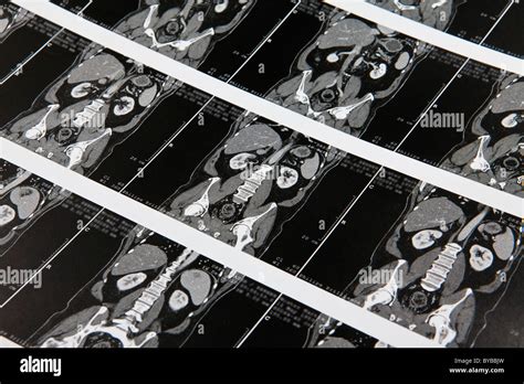 Multi Slice Computed Tomography Magnetic Resonance Imaging Mri