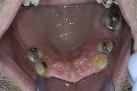 Gingivectomy Cost A Comprehensive Guide To Procedure Pricing And