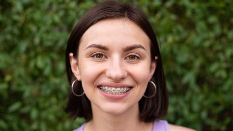 Why Do People Need Braces A Complete Guide