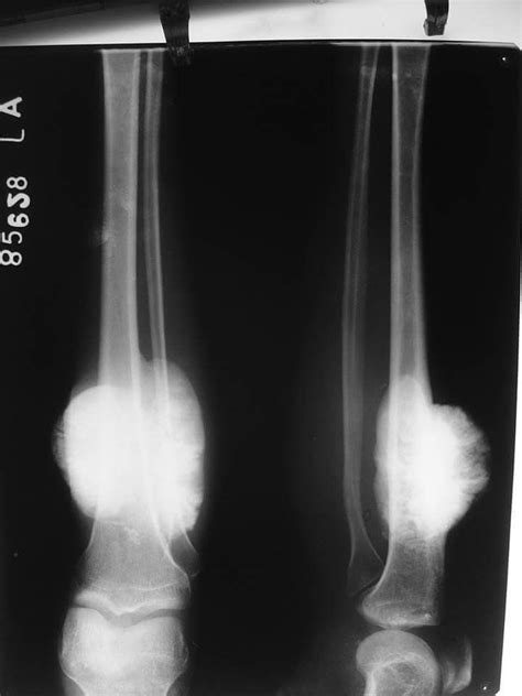 Osteosarcoma Sunburst Appearance