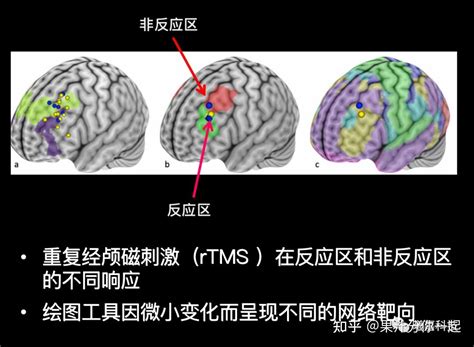 曦嘉医疗 经颅磁刺激tms 抑郁症研究：应用连接组学进行精准靶向刺激 知乎
