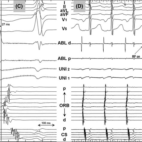 Focal Atrial Tachycardia Termination During Radiofrequency Ablation At