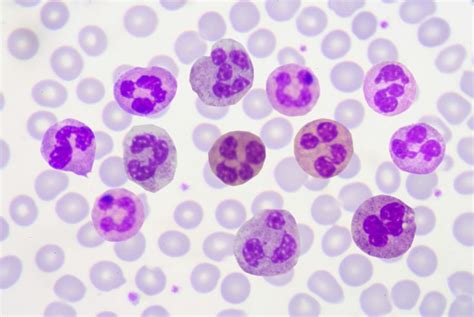 The Enigma Rare Polymorphonuclear Leukocytes Explained