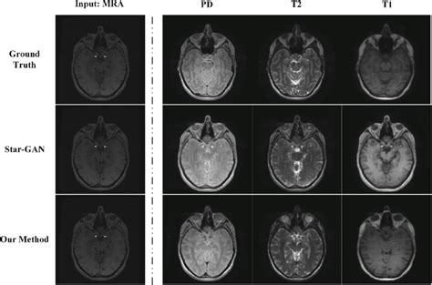 Synthesis Of Pd T2 Weighted And T1 Weighted Images Using A Single Mra Download Scientific