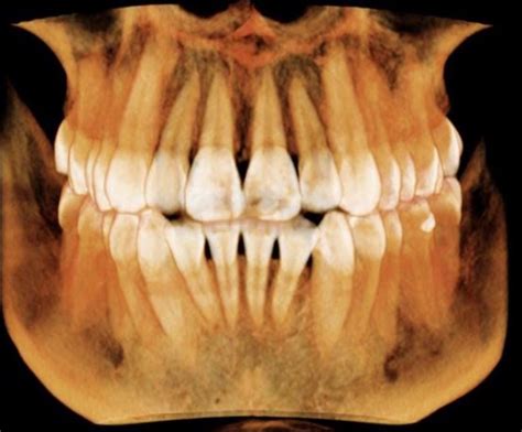 Cone Beam 3d Imaging Root Canals In South Miami Fl By Fdg Endo