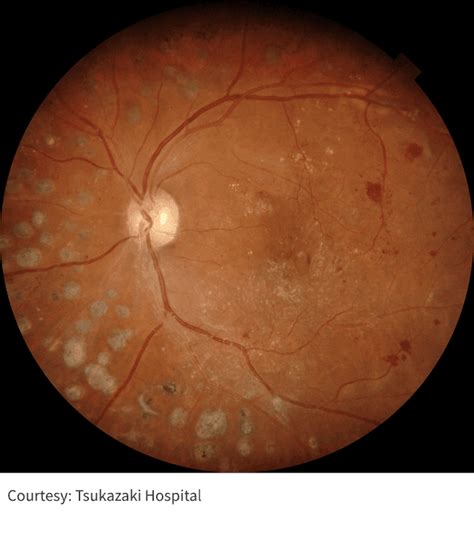Topcon Nw500 Non Mydriatic Retinal Camera