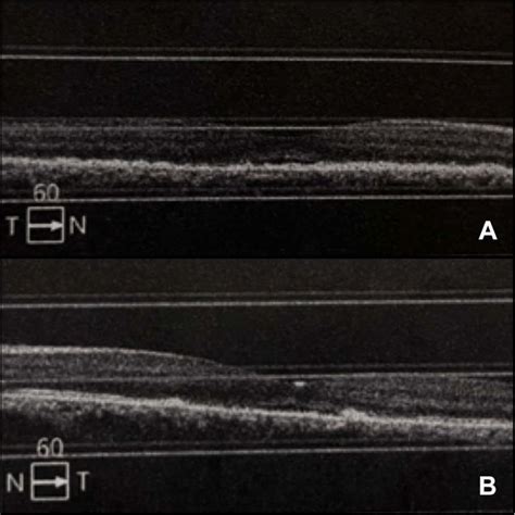 Optical Coherence Tomography Oct Indicates Minimal Subretinal Fluid Download Scientific