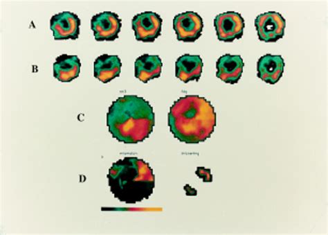 Prevalence Of Hibernating Myocardium In Patients With Severely Impaired Ischaemic Left