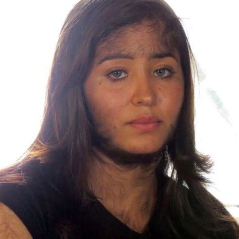 Indication Hypertrichosis Everlastwellness