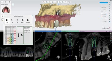 Dental Implant Treatment From Start To Finish Using 3shape Trios