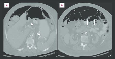 A B Ct Scan Of The Abdomen Demonstrating Severe Circumferential Download Scientific Diagram