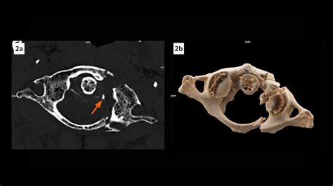 A Dens Fracture Invisible To Visible Siemens Healthineers Slovakia A Dens Fracture Invisible To Visible Siemens Healthineers Slovakia