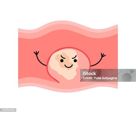 인체 장기의 벽 안쪽에 폴립 특성 암 악성 종양 인간 소화 기관 기관의 위험이 있습니다 대장암 세포 평면 그림 가공의 인물에 대한 스톡 벡터 아트 및 기타 이미지 Istock