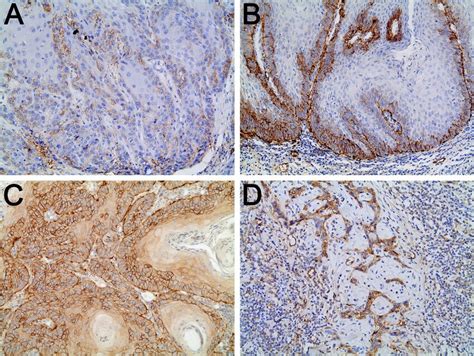 A And B Expression Of Podoplanin In Neoplastic Cells Of Oral Squamous Download Scientific