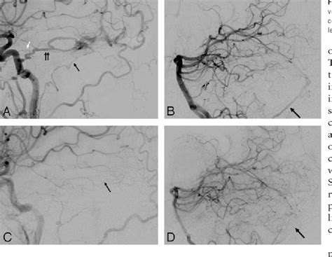 Figure 5 From Preliminary Experience With Onyx Embolization For The Treatment Of Intracranial