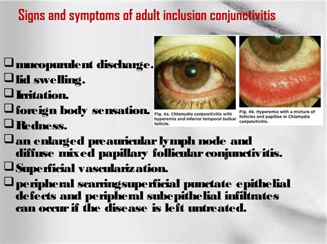 Chlamydia Conjunctivitis Ppt