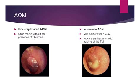 Conservative Management Of Otitis Media Pptx