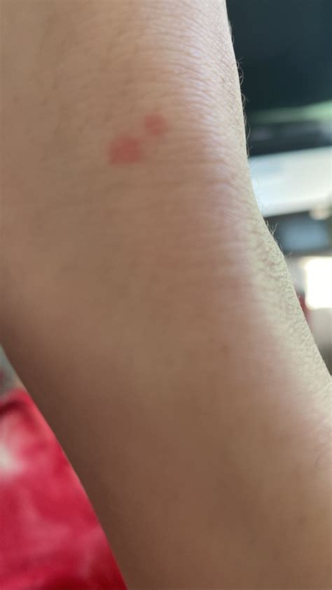 Червени петна по кожата Здравословни проблеми Мнения от Bg Mamma